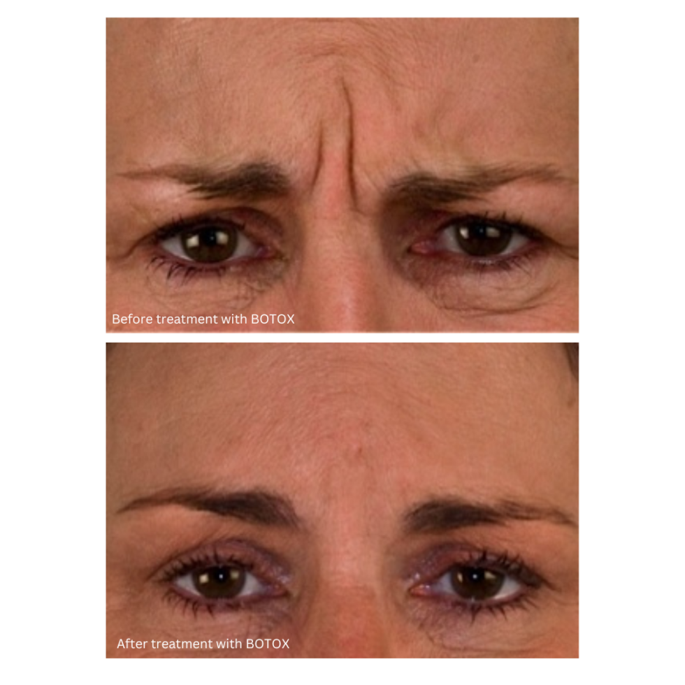 Faceworks - Cosmetic Experts Administering Botox In Auckland For 20 Years